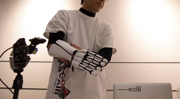 USD 300 myoelectric hand is controlled electronically by nerves ...